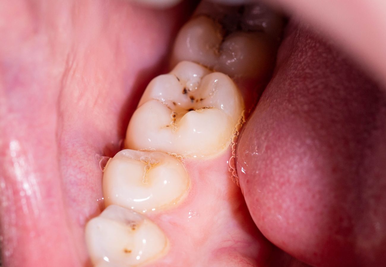 Caries en los dientes: ¿qué hacer? - ZIGOMAT