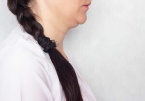 Retrognatia mandibular: Soluciones - ZIGOMAT