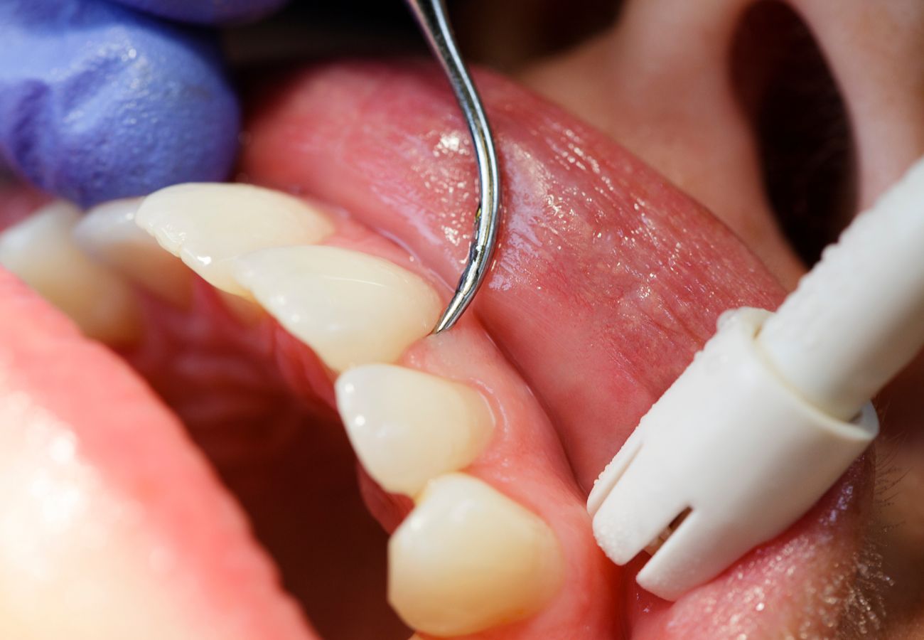 Descubre cómo tratar la gingivitis - ZIGOMAT
