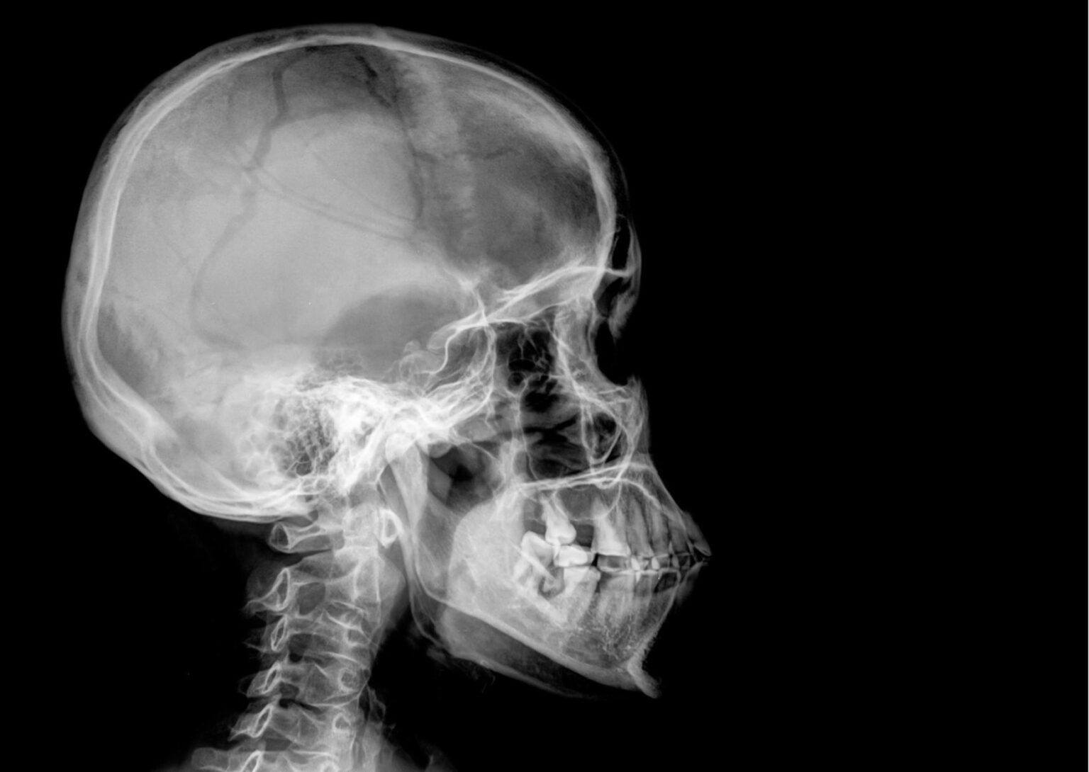 Dolor de mandíbula causas y recomendaciones - ZIGOMAT