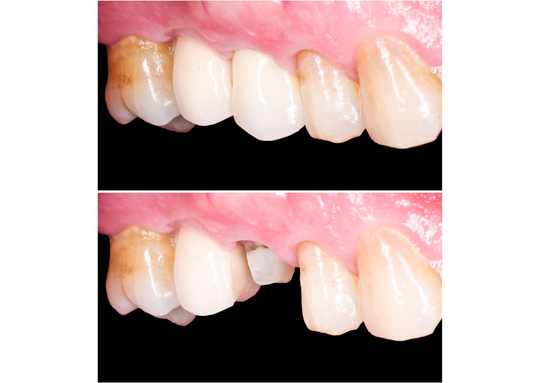 Coronas de zirconio antes y después - ZIGOMAT